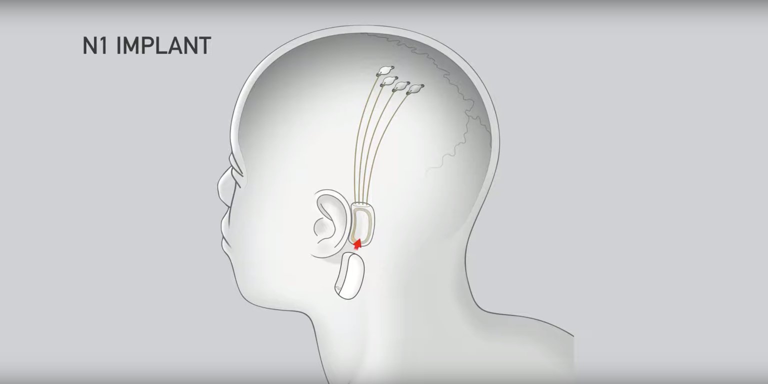 Neuralink To Begin Human Trials - NeuroLogica Blog