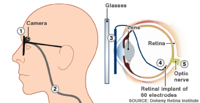 Progress on Bionic Eye - NeuroLogica Blog